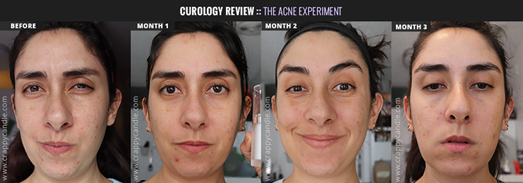 Curology Review - The Acne Experiment | Crappy Candle