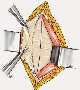 DR. JUAN HERNÁNDEZ ORDUÑA. : Apendicectomia abierta texto