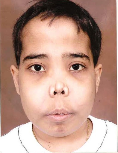 CLINICAL FEATURES AND LABORATORY FINDINGS OF THALASSEMIA