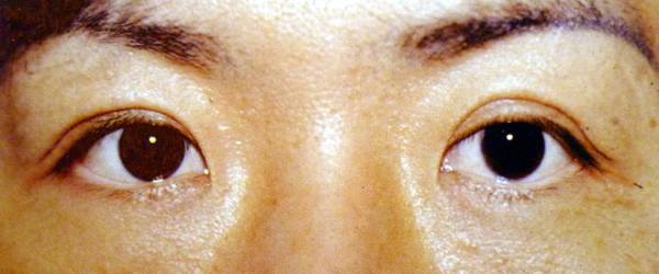Eyelid Surgery by Prof Dr CN CHUA 蔡鐘能: Complications of Double Eyelid ...