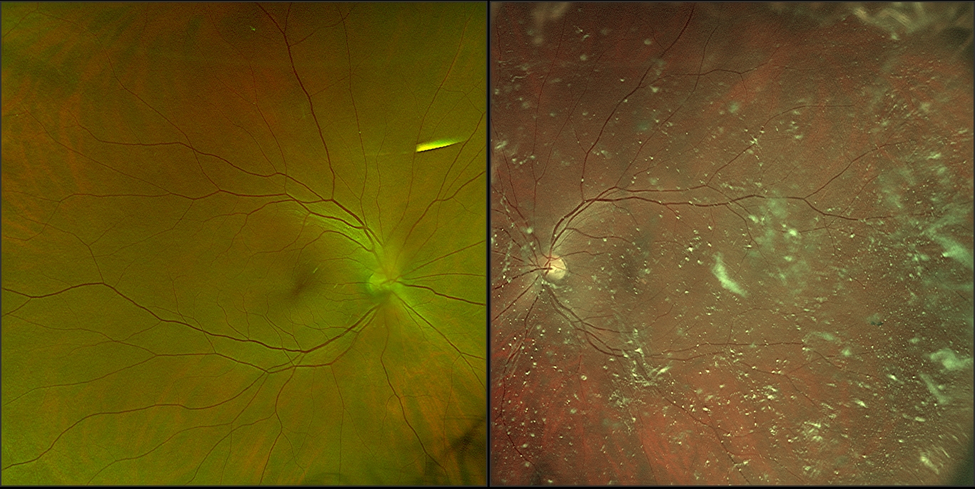 Asteroid Hyalosis Retina