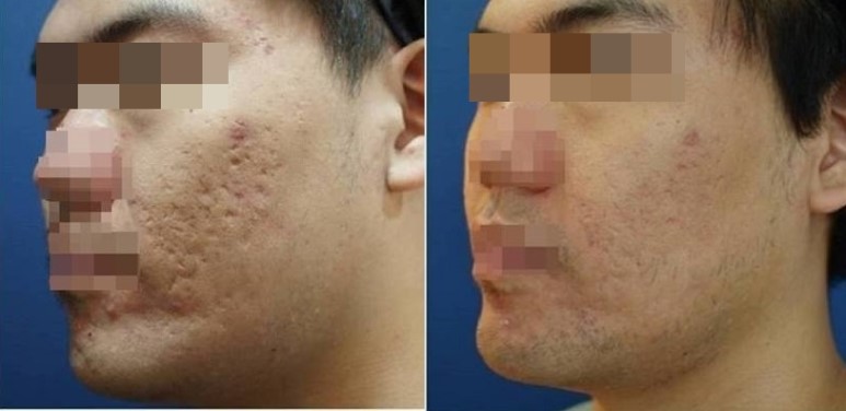 Renewme Skin Clinic: NEW 2019 Acne scar treatment; DNA Dermal Rejuvenation
