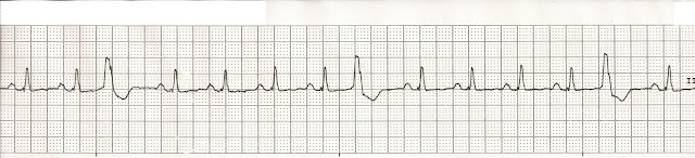 EKG Rhythm Strips 26: Ectopic beats