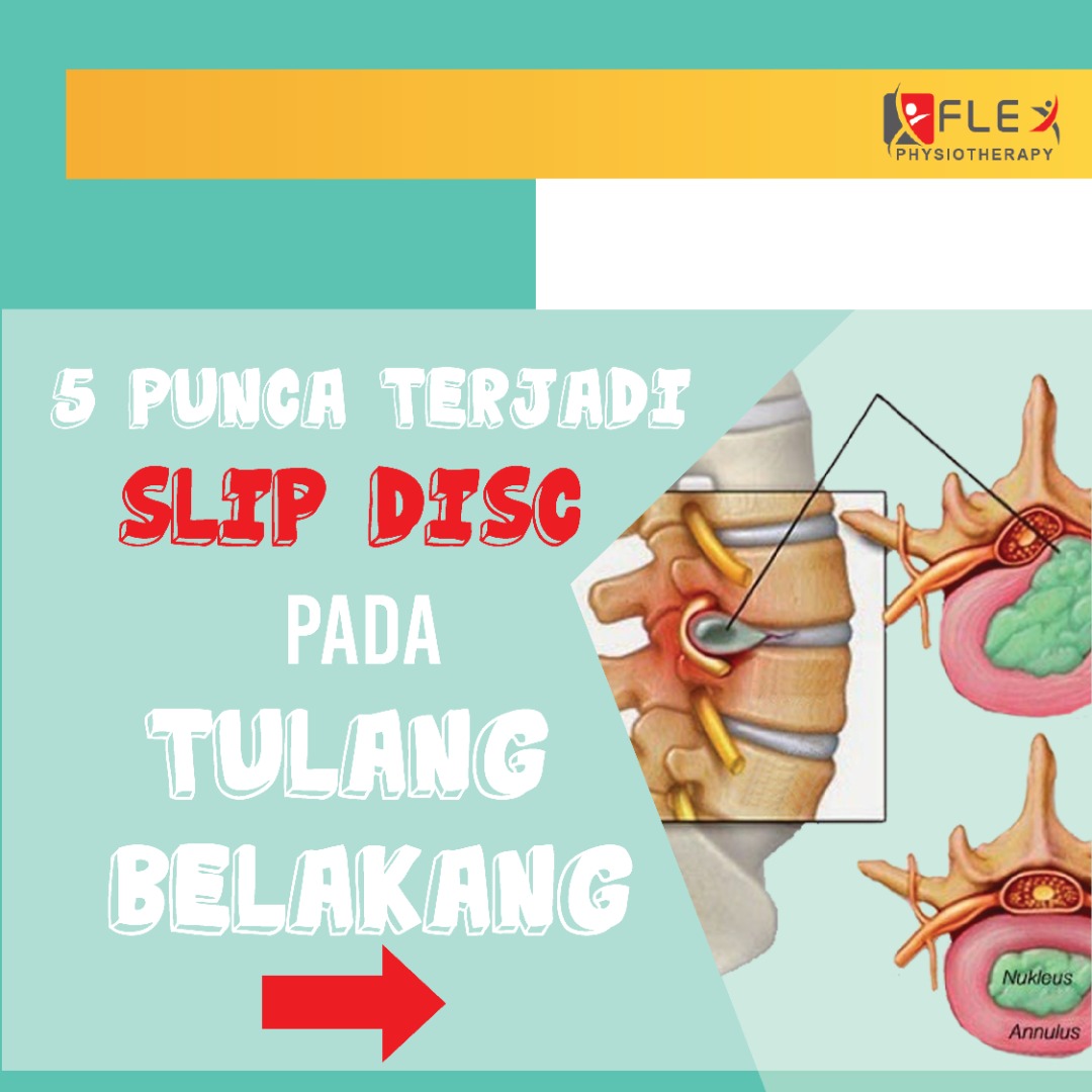 FLEX PHYSIOTHERAPY: 5 punca terjadinya slip disc pada tulang belakang
