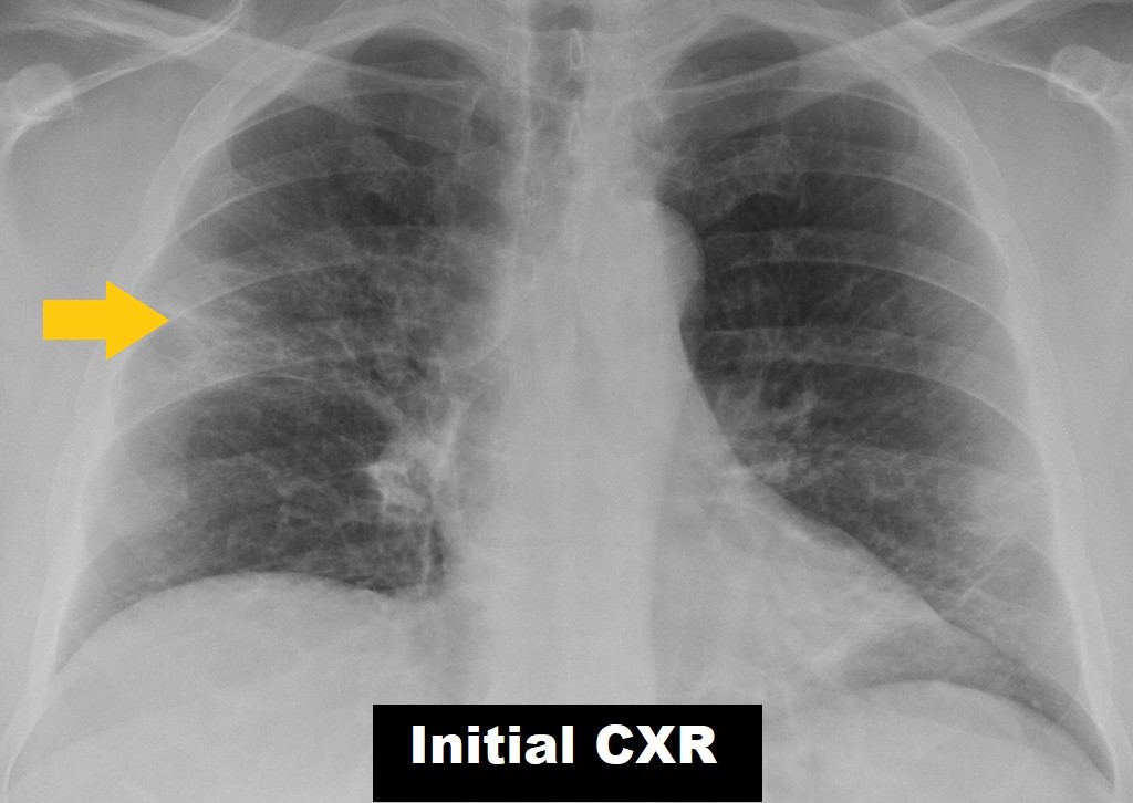 CXR in COVID19 - Sumer's Radiology Blog