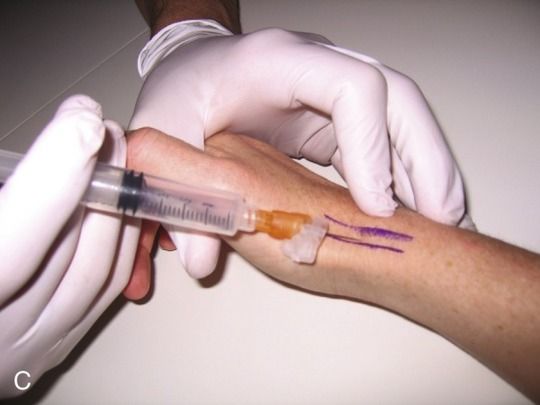 DE QUERVAIN's TENOSYNOVITIS - Pain at the side of the wrist | The ...