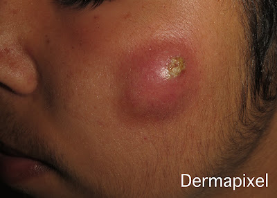 Dermapixel: Un poco más que un grano