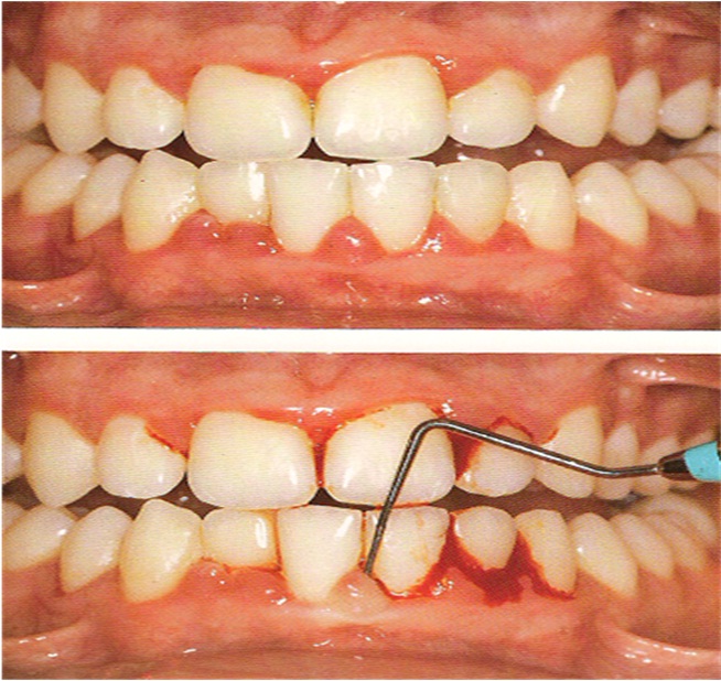 Regina Manara: ATENÇÃO AOS SINAIS E SINTOMAS DAS DOENÇAS PERIODONTAIS