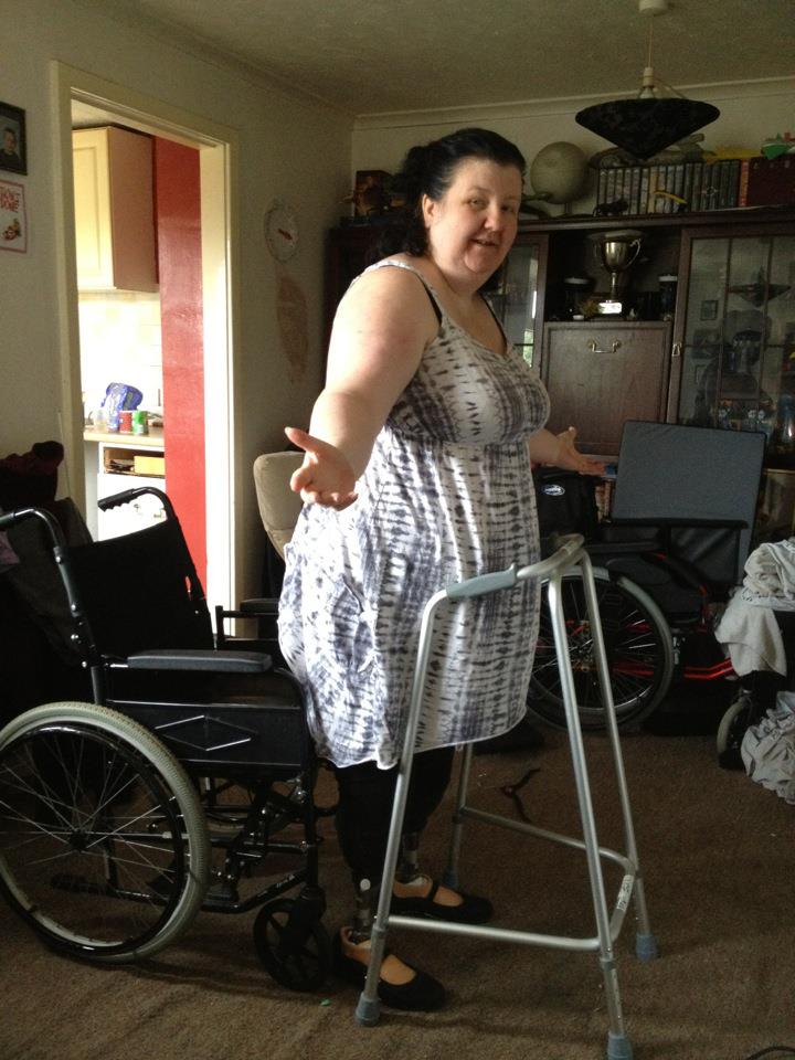 To live with an Amputation: ALL CHANGE....AGAIN