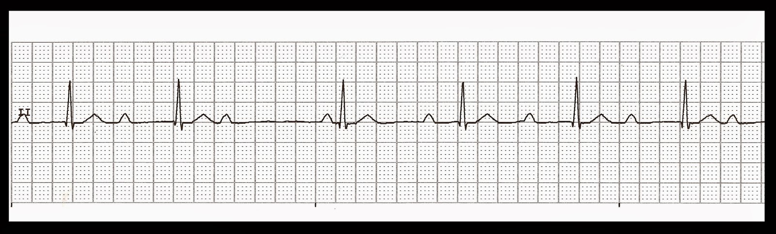Practice EKG Strips 386
