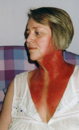 Radiation Treatment: March 2016