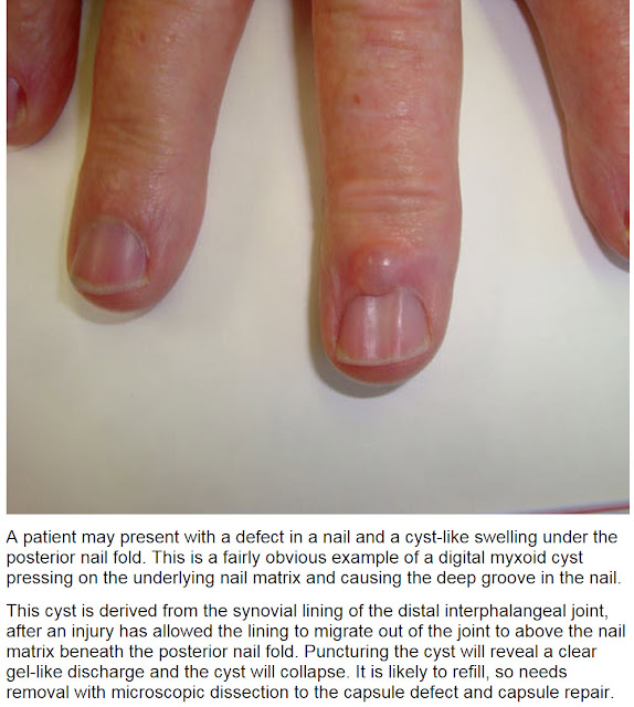 Consultations in Dermatology: Mxoid cyst nail