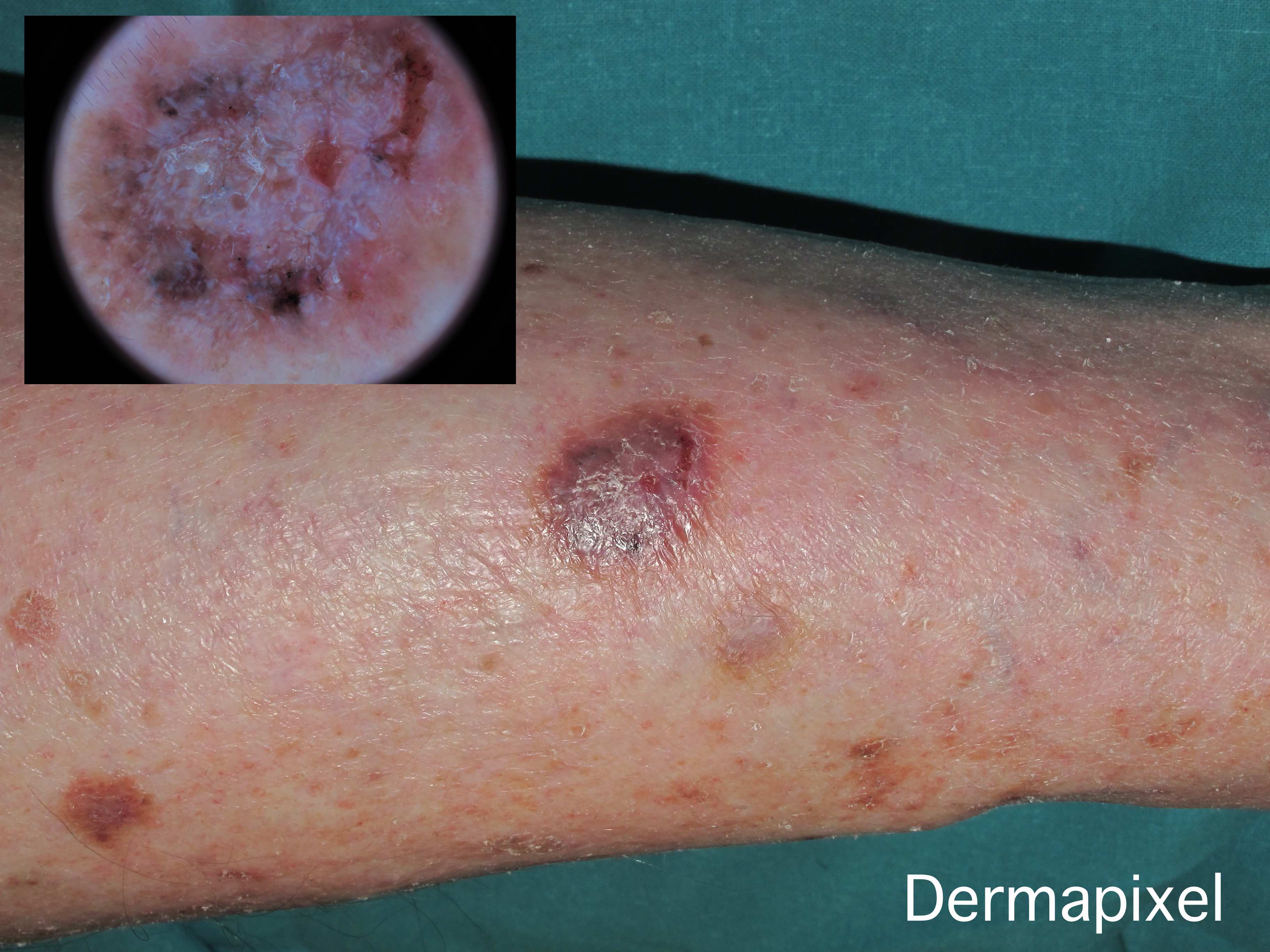 Dermapixel: Una mancha que crece