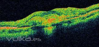DEGENERACION MACULAR : DMAE SECA. OCT DE CONTROL