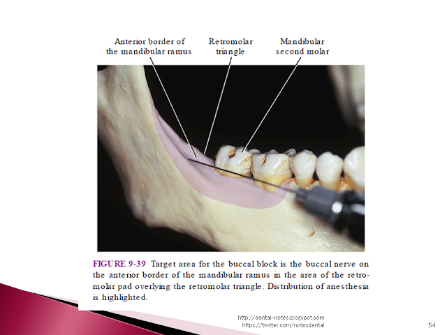 Dental Notes: Long Buccal Nerve Block NOTES