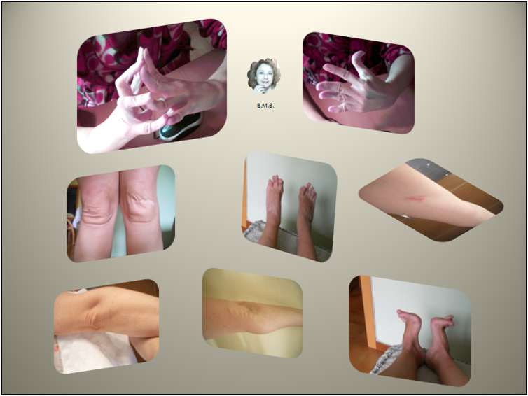 SÍNDROME DE EHLERS DANLOS