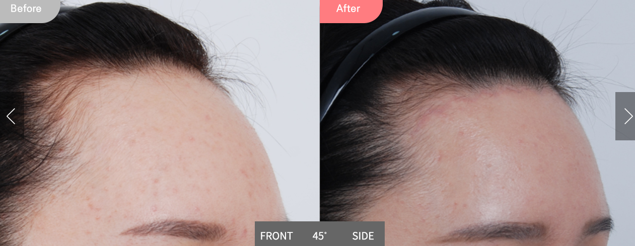 [ATOP Plastic Surgery Korea] Forehead Reduction (Forehead shortening ...