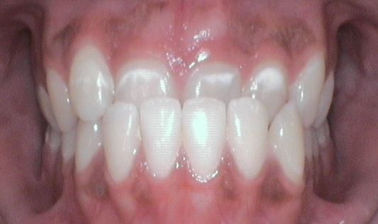 Causes of Open bite, Deep bite, crowding, Generalized spacing, Midline ...