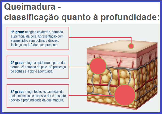 Dicas de Enfermagem: Queimaduras