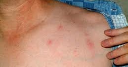 "The art of staying healthy": Symptoms of Bites From Dust Mites