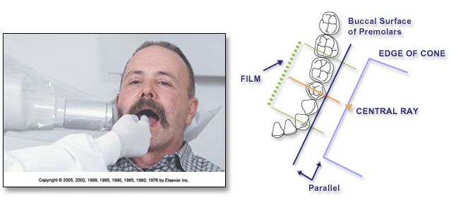 Dentistry and Medicine: Intraoral Radiographic Techniques (Bitewing ...