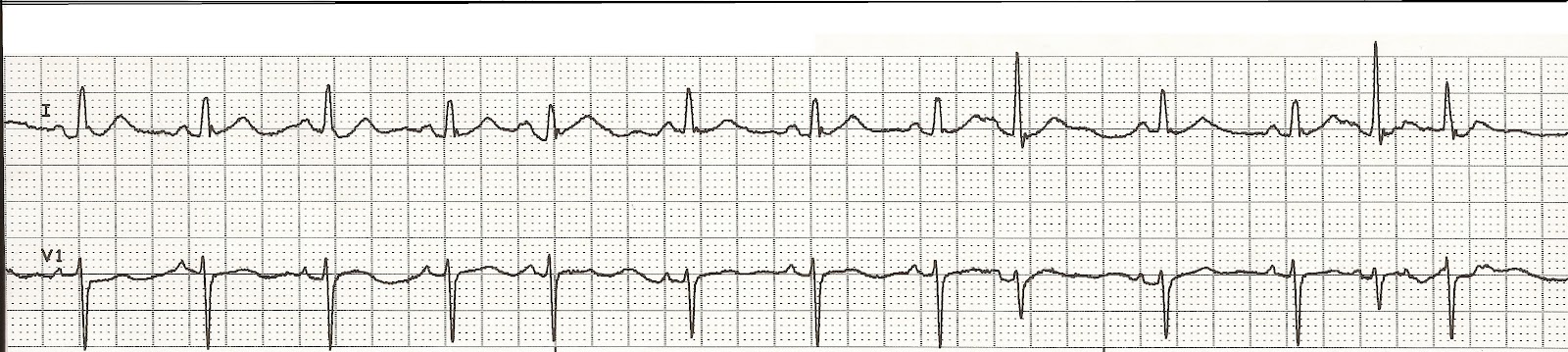 EKG Rhythm Strip Quiz 19