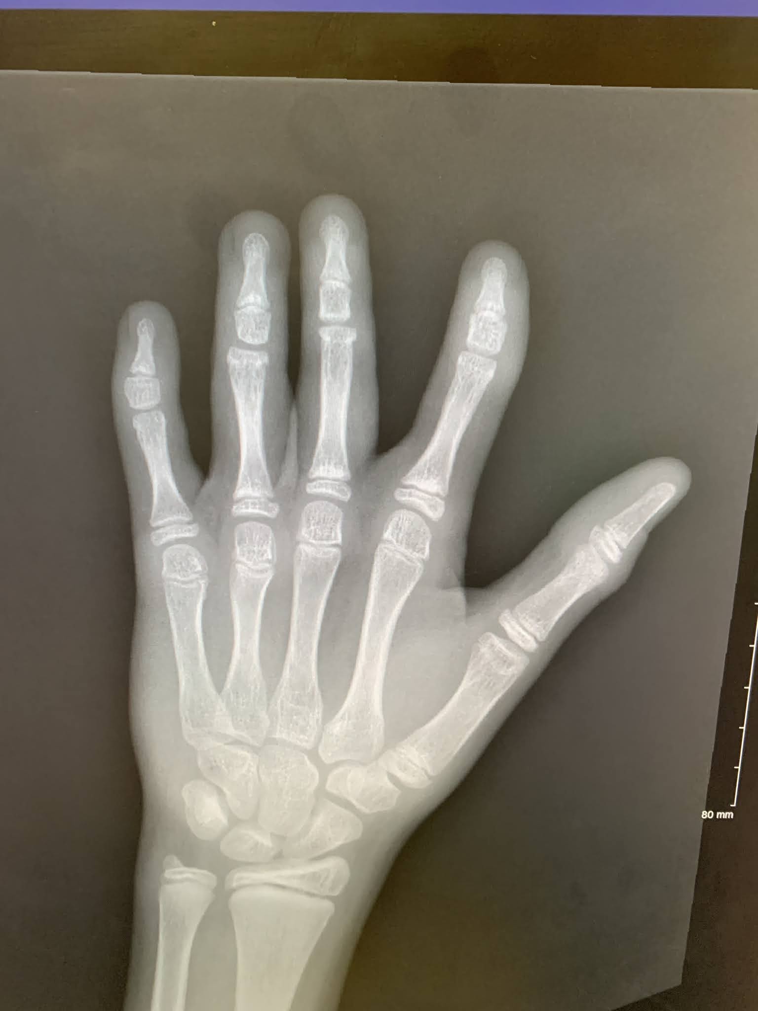 Congenital Hand and Arm Differences