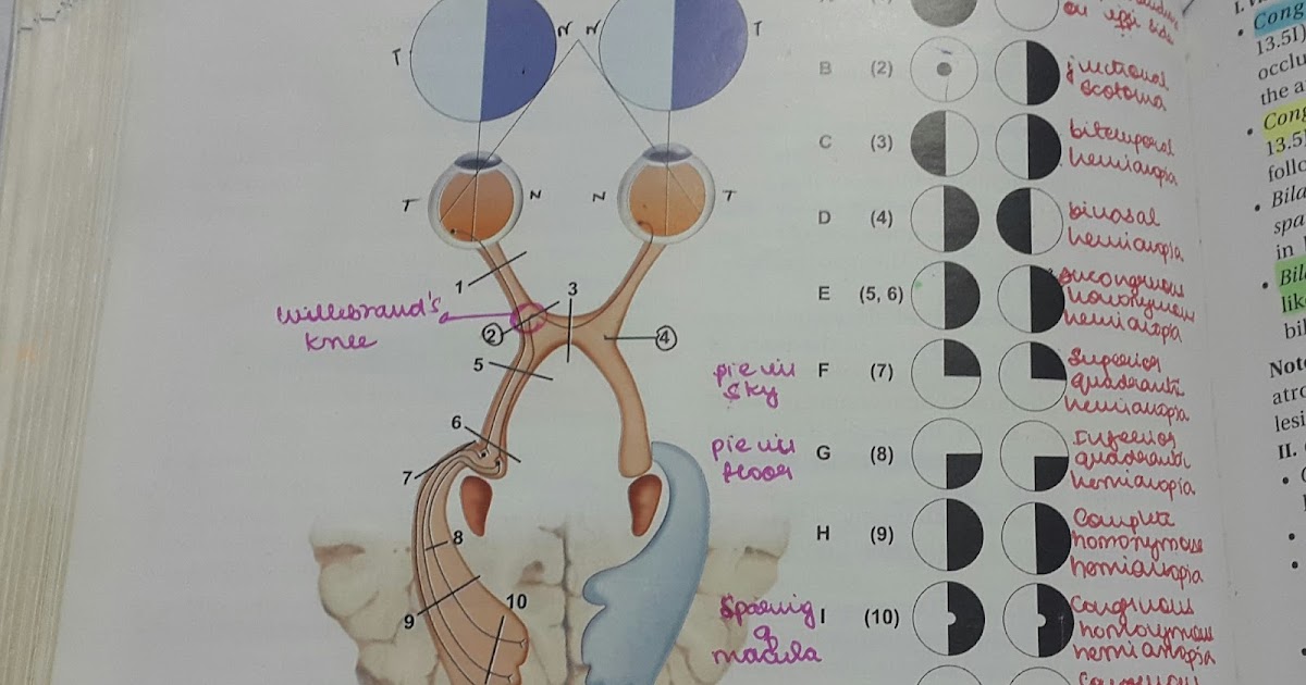 Medicowesome: Lesions of visual pathway