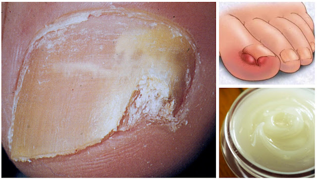 Elimina los hongos con este tratamiento casero en solo 4 días