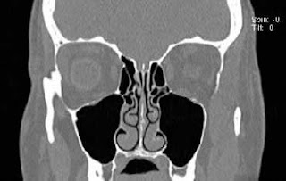 When is Sinus Surgery Appropriate for Recurrent or Chronic Sinus ...