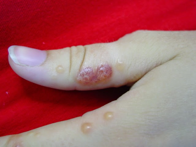 Dermatopathology Made Simple - Inflammatory: Spongiotic Reaction Pattern