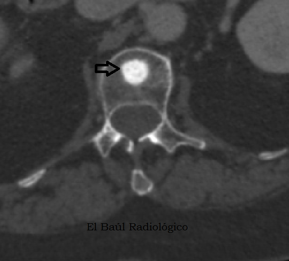 El Baúl Radiológico: ENOSTOSIS: ISLOTE ÓSEO (Bone Island: CT and MRI ...