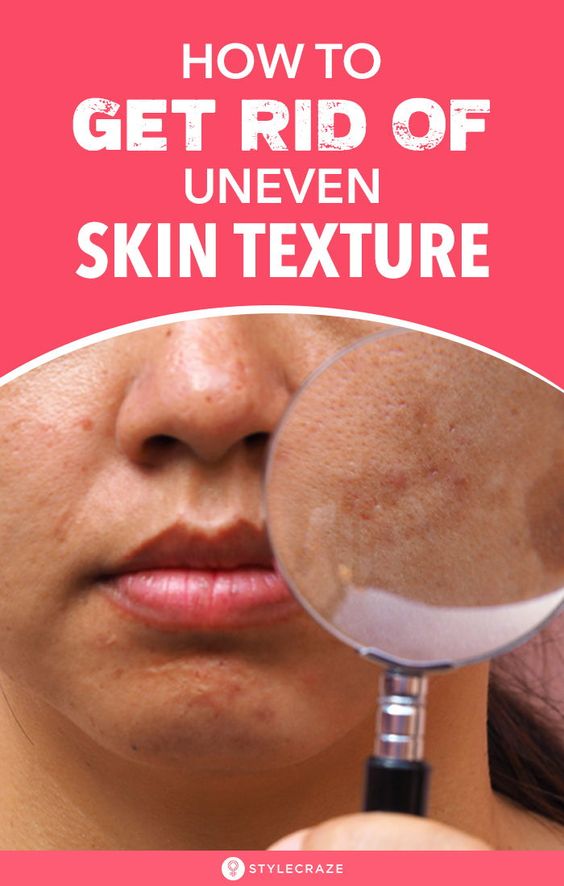 How To Get Rid Of Uneven Skin Texture - Diet Sehat