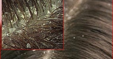 This is an Effective Way to Overcome Dandruff in Children - ReadyyGo