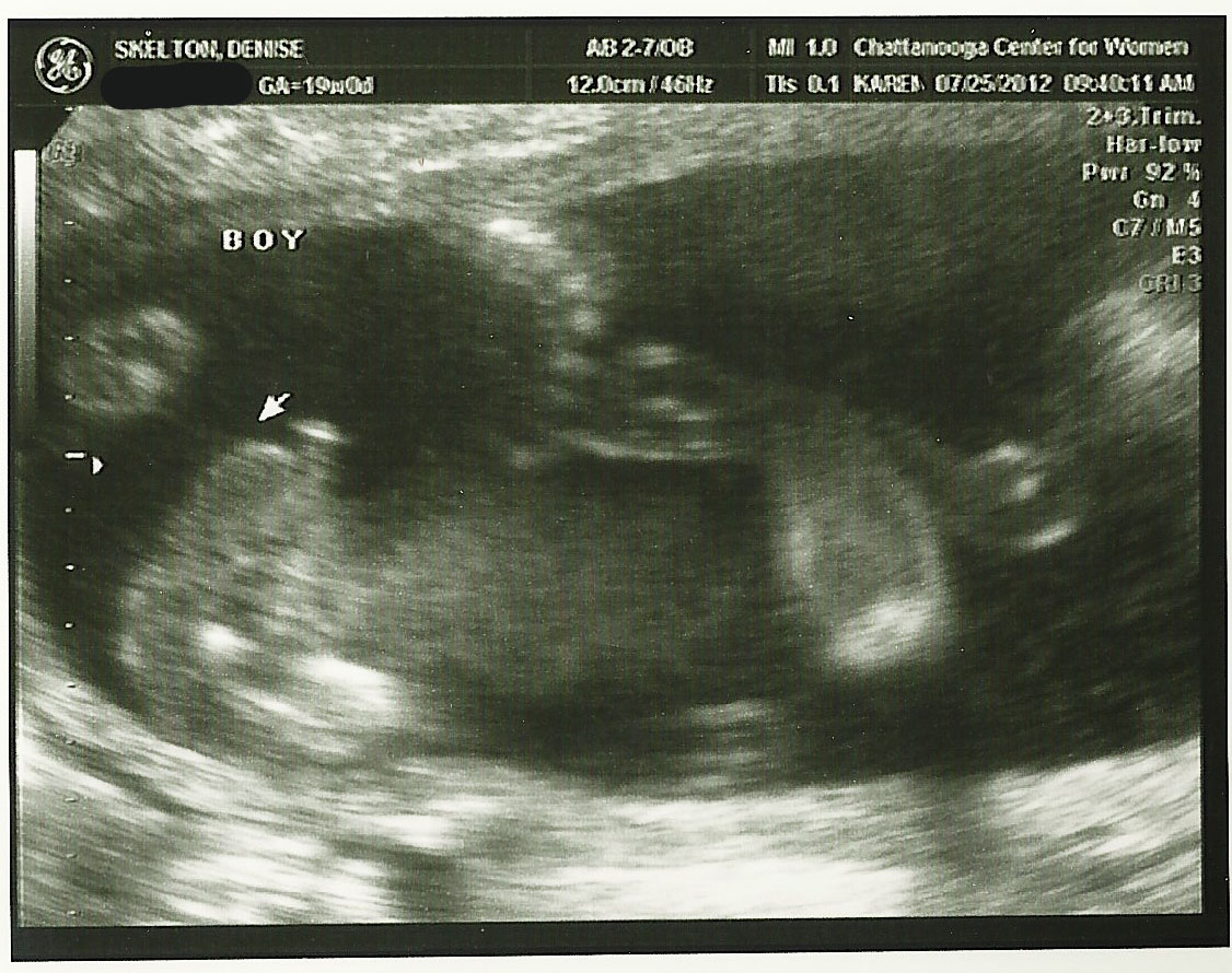 Arrows in Our Hand: 19 Week Ultrasound