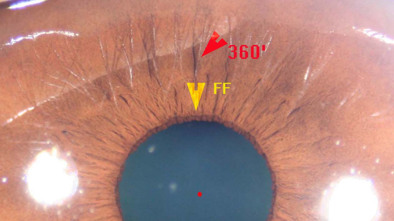 Modern And Multidimensional Iridology Radial Furrow At 360 And Frontal