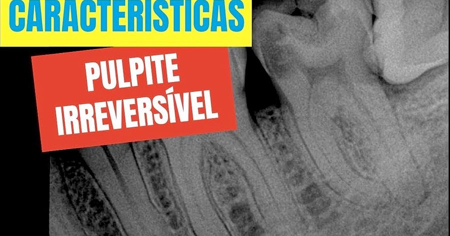 PULPITE IRREVERSÍVEL: Características - Fernanda Signoretti, MSc, Ph.D ...
