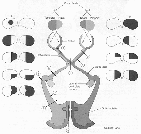 Getting past double vision one day at a time: Strabismus, visual field ...