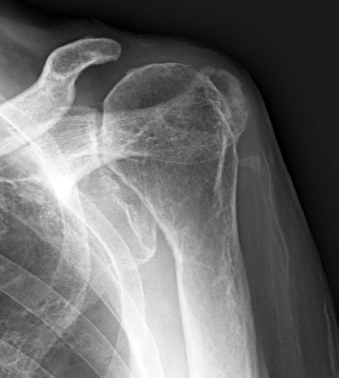 UW Shoulder and Elbow Academy: Reverse total shoulder - choosing a ...