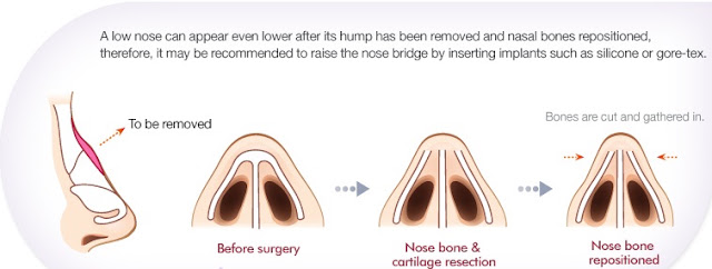 BK Plastic Surgery: BK STYLE SMART NOSE - Hooked Nose Reshaping