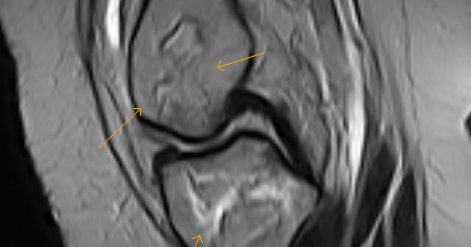 Knee-Avascular Necrosis-MRI - Sumer's Radiology Blog
