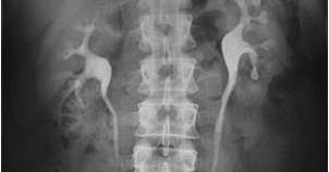 Radiografer Muda: TEKNIK RADIOGRAFI BNO IVP