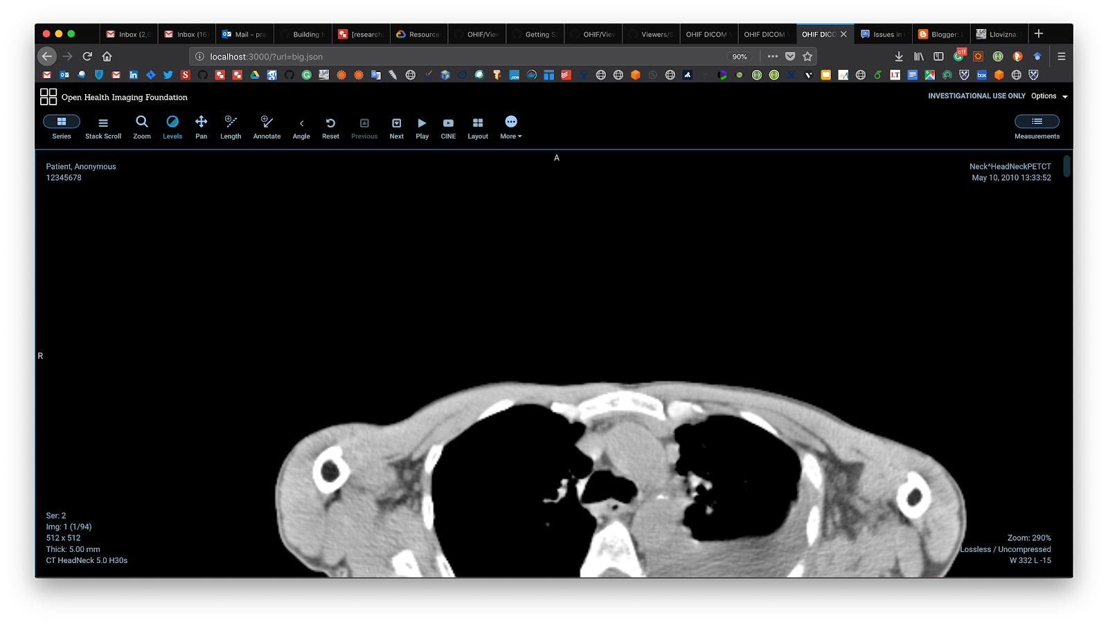Llovizna: Installing Standalone Viewer of OHIF
