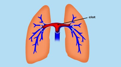 What is Saddle Pulmonary Embolism - Definition, Symptoms, Causes ...