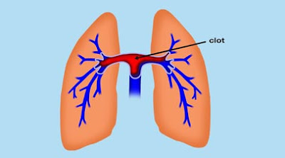What is Saddle Pulmonary Embolism - Definition, Symptoms, Causes ...