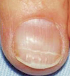 Dicas de Enfermagem: Relação das unhas e saúde geral