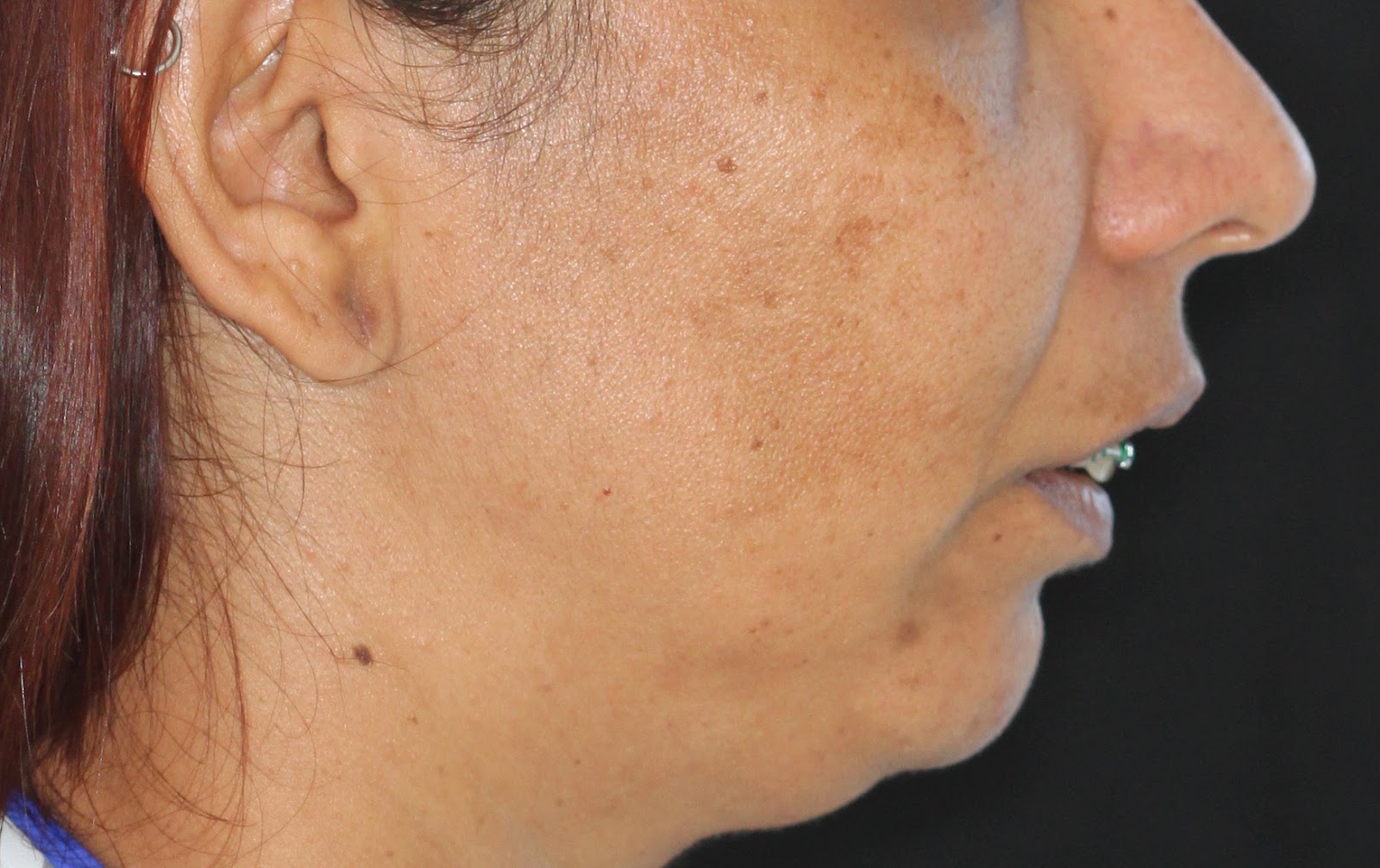 Ortodontia é Arte: Classe II