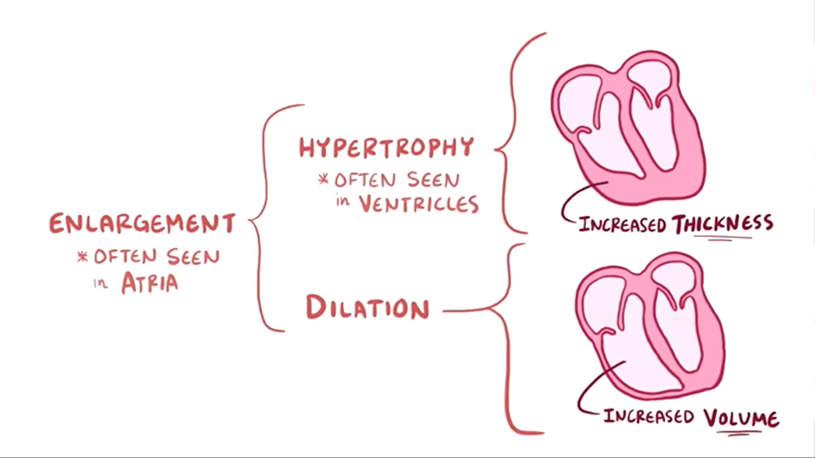 EKG DERS 7; HIPERTROFI ve GENISLEME