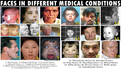 FACES IN DIFFERENT MEDICAL CONDITIONS - Stunning Interesting Facts