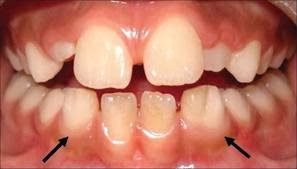 www.BestOgdenDentist.com Blog: My child has 2 teeth that looked they ...
